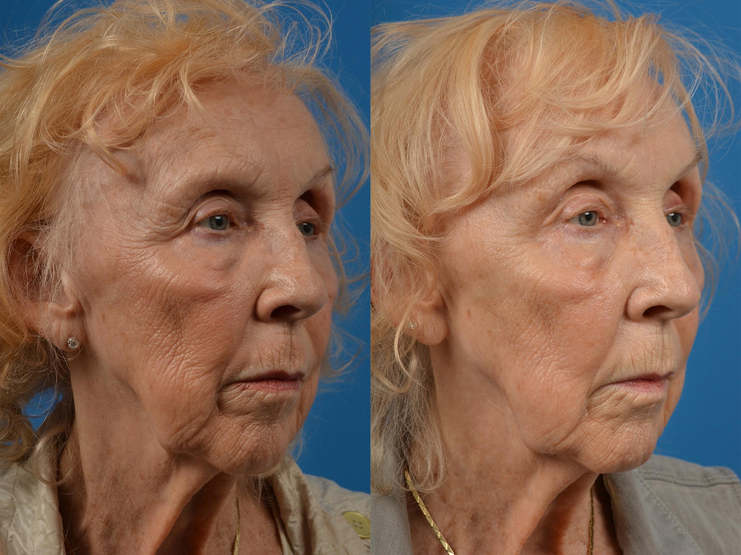 Brow Lift Photos Melbourne Fl Patient 53342